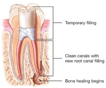 Root Canal Retreatment - Winnetka Endodontics